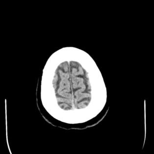 Alzheimer’s Disease: What Is Alzheimer’s Disease And How Does It Look ...